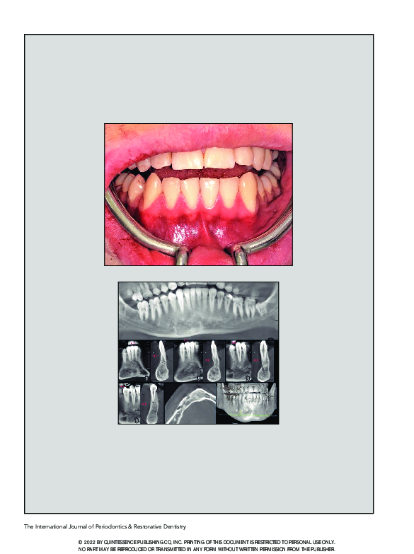 (PDF) Traumatic Mandibular Cyst Defect Grafted with Autologous Dentin ...