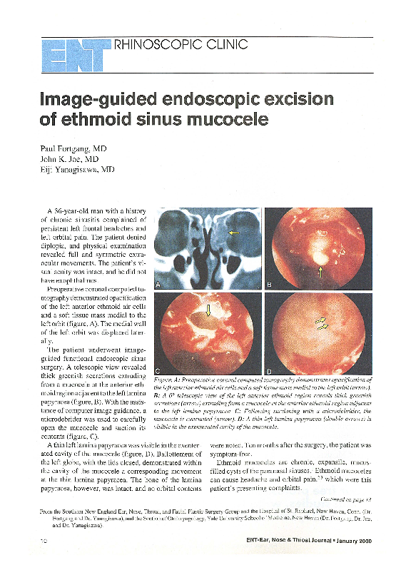 (PDF) Image-guided Endoscopic Excision of Ethmoid Sinus Mucocele | john ...