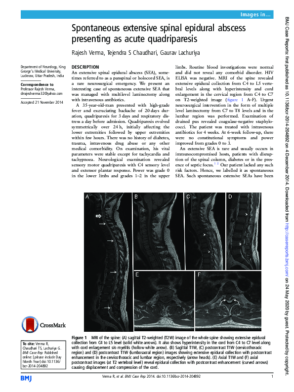 Pdf Spontaneous Extensive Spinal Epidural Abscess Presenting As Acute