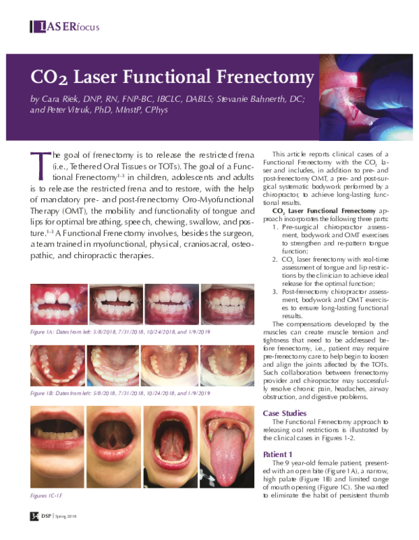 (PDF) CO2 Laser Functional Frenectomy