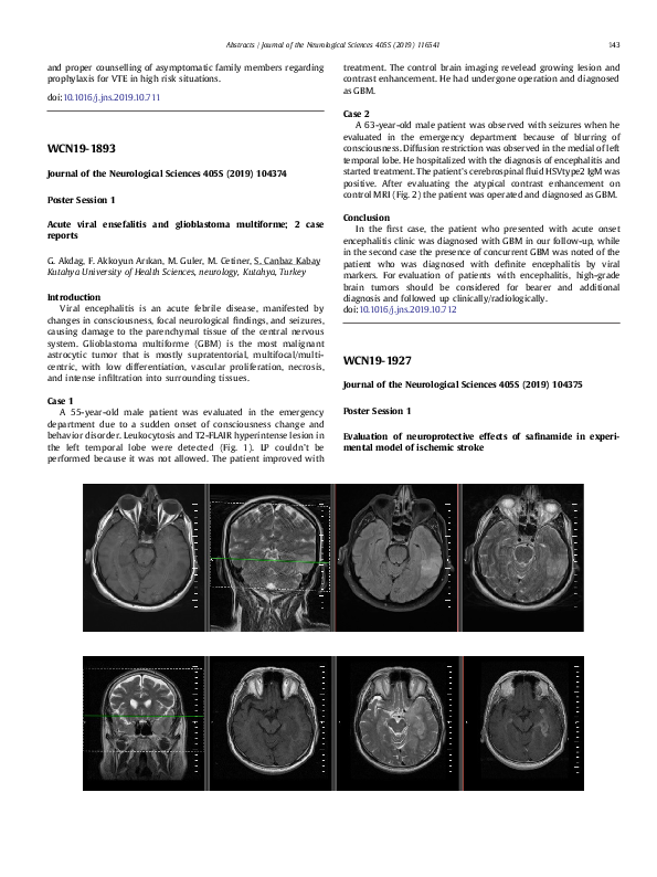 (PDF) Acute viral ensefalitis and glioblastoma multiforme; 2 case reports