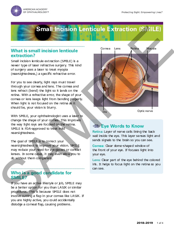 (PDF) Small Incision Lenticule Extraction (SMILE)