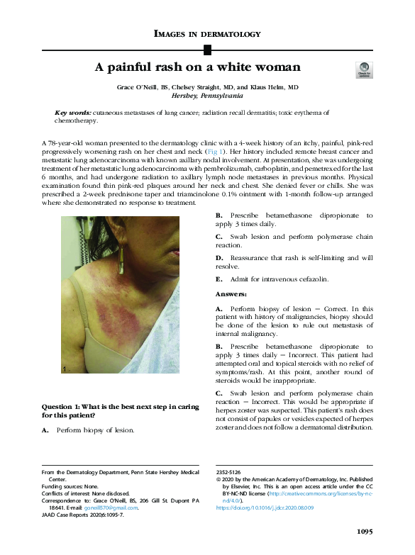 (PDF) A painful rash on a white woman