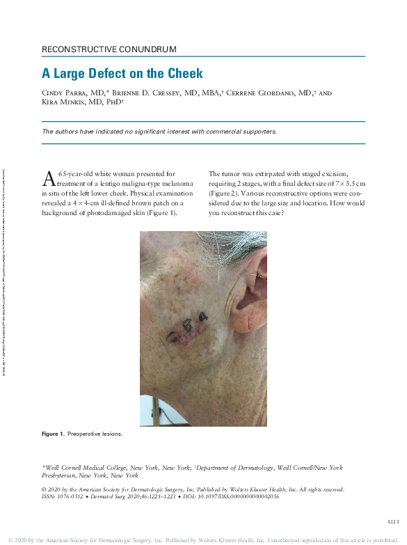 (PDF) A Large Defect on the Cheek