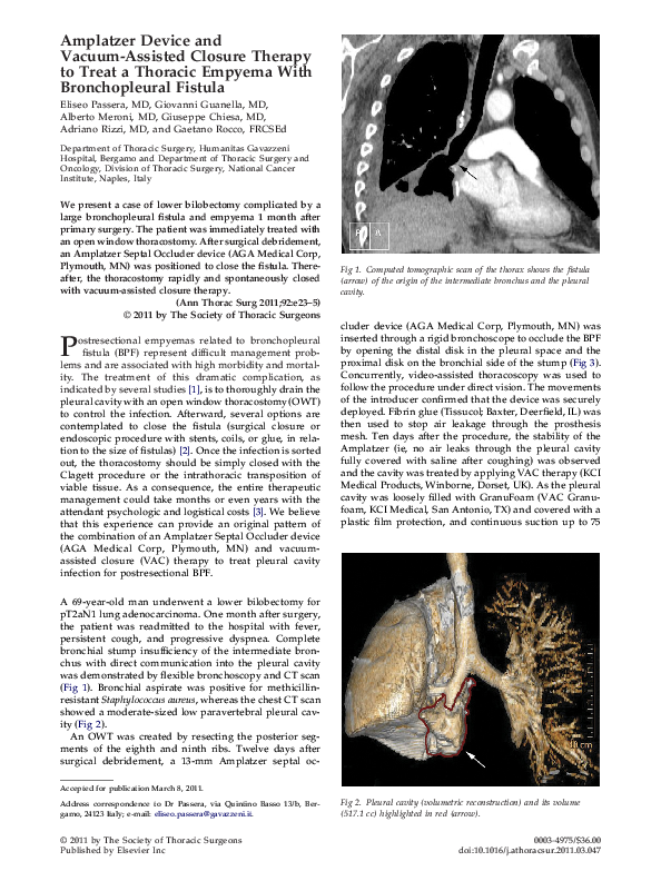 (PDF) Amplatzer Device and Vacuum-Assisted Closure Therapy to Treat a Thoracic Empyema With ...
