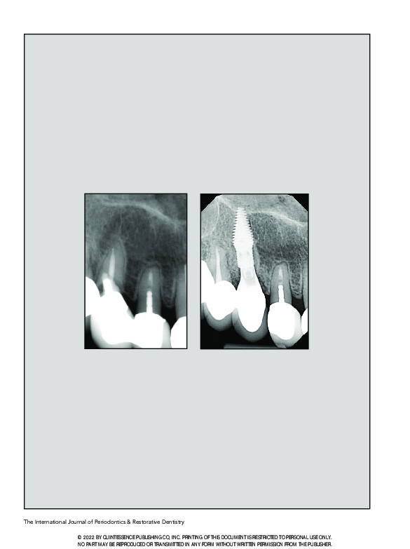 (PDF) Changes in Peri-Implant Soft Tissue Thickness with Bone Grafting ...