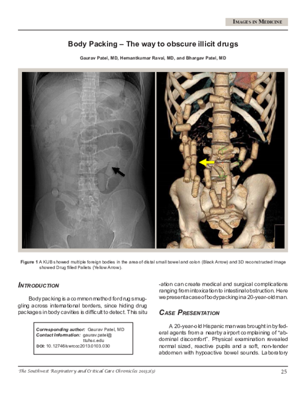 (PDF) Body Packing – The way to obscure illicit drugs