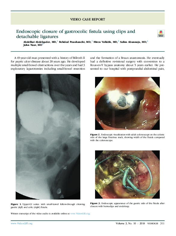 (PDF) Endoscopic closure of a gastrocolic fistula using the over-the ...