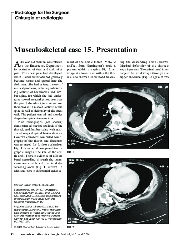 (PDF) Musculoskeletal case 15. Presentation. Marfan's syndrome