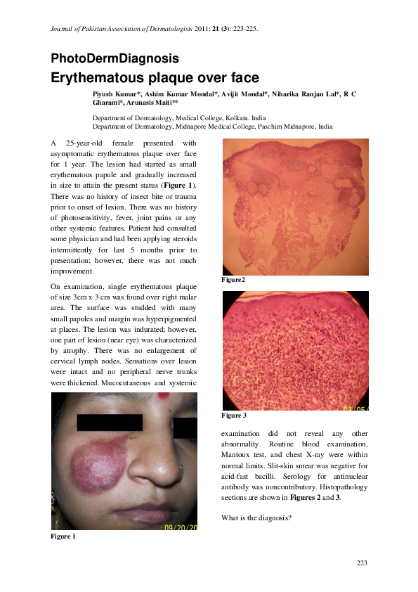 (PDF) Erythematous plaque over face