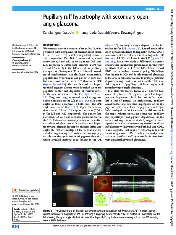 (PDF) Pupillary ruff hypertrophy with secondary open-angle glaucoma