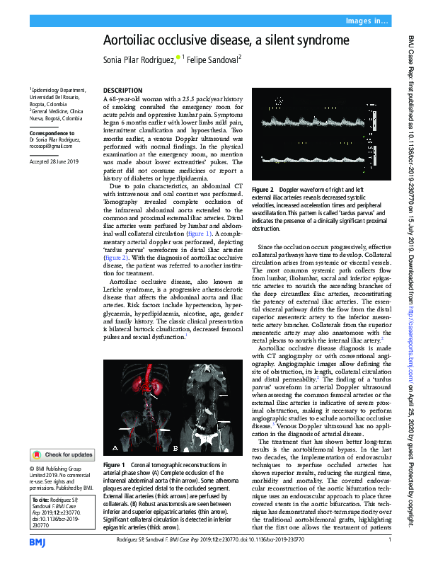 (PDF) Aortoiliac occlusive disease, a silent syndrome