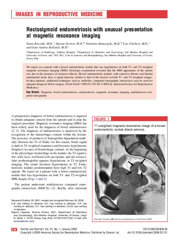 (PDF) Rectosigmoid endometriosis with unusual presentation at magnetic resonance imaging