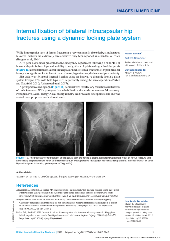 (PDF) Internal fixation of bilateral intracapsular hip fractures using ...