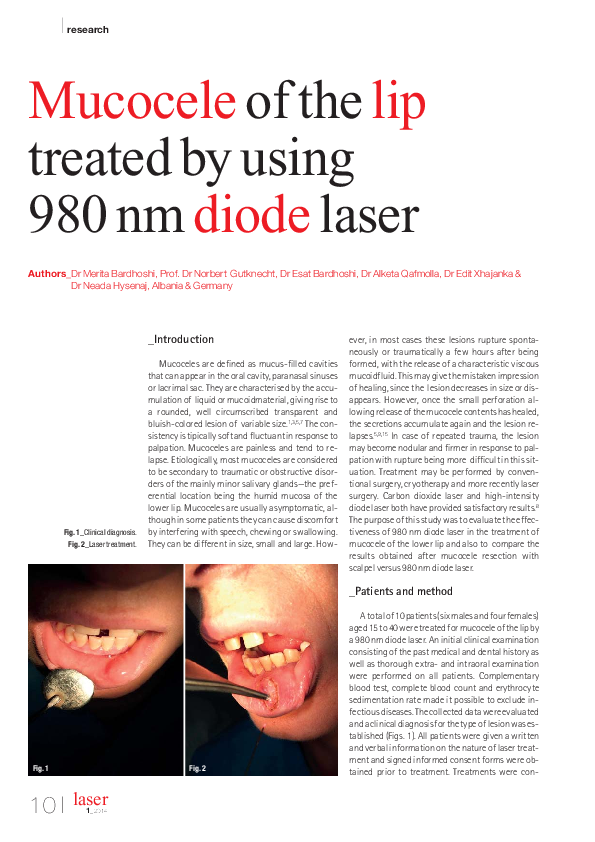 (PDF) Mucocele of the lip treated by using 980 nm diode laser