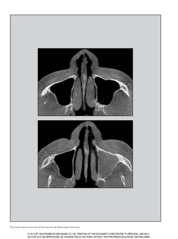 (PDF) Evaluation of Health or Pathology of Bilateral Maxillary Sinuses ...