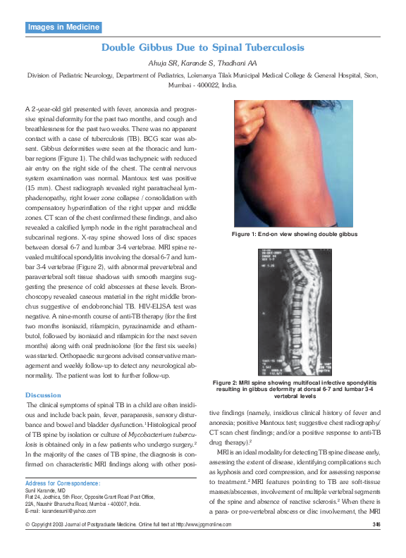 (PDF) Images in medicine. Double gibbus due to spinal tuberculosis