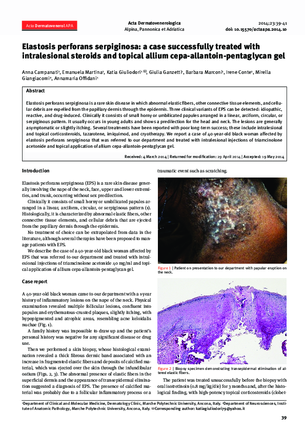 (PDF) Successful EPS Treatment with Steroids and Gel