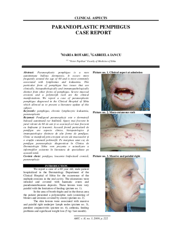 (PDF) Paraneoplastic Pemphigus Case Report | Maria Rotaru - Academia.edu