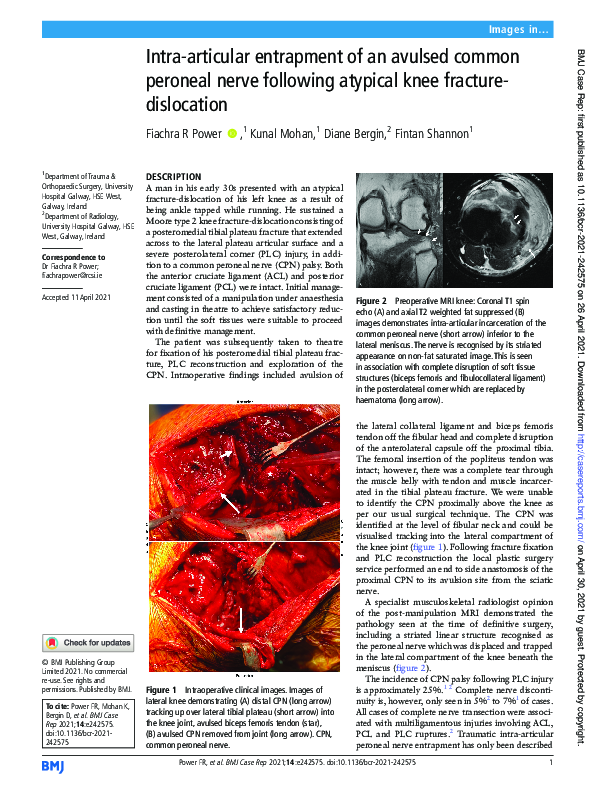(PDF) Intra-articular entrapment of an avulsed common peroneal nerve ...