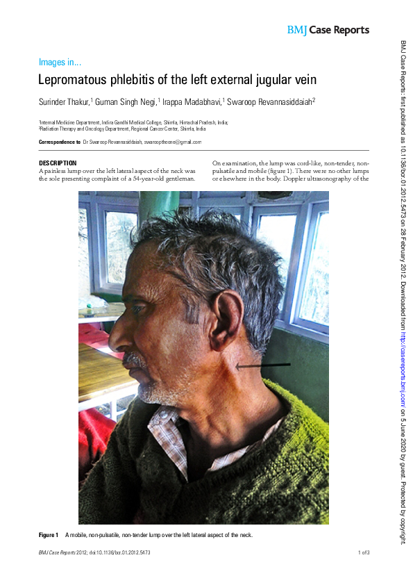 (PDF) Lepromatous phlebitis of the left external jugular vein | Irappa ...