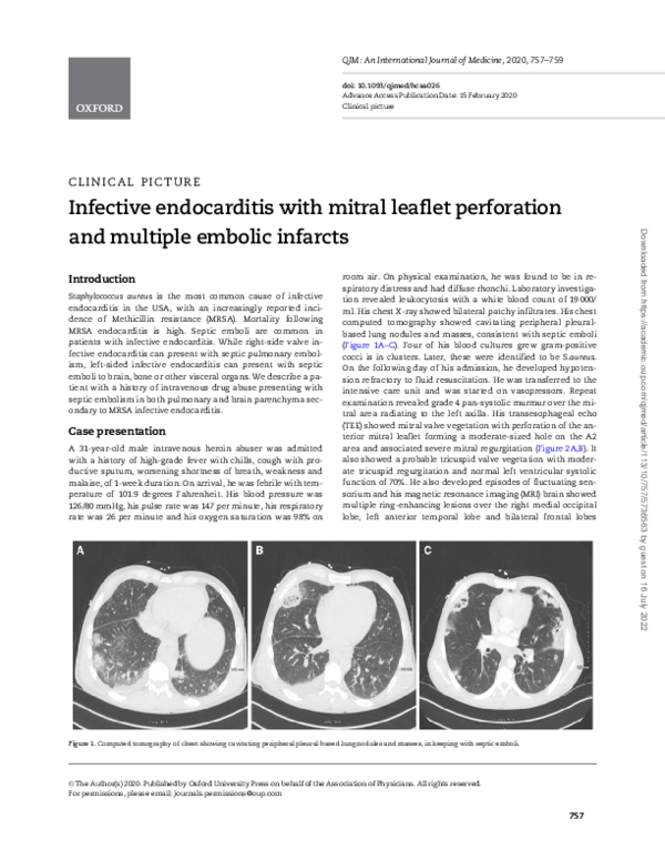 (PDF) Infective endocarditis with mitral leaflet perforation and ...