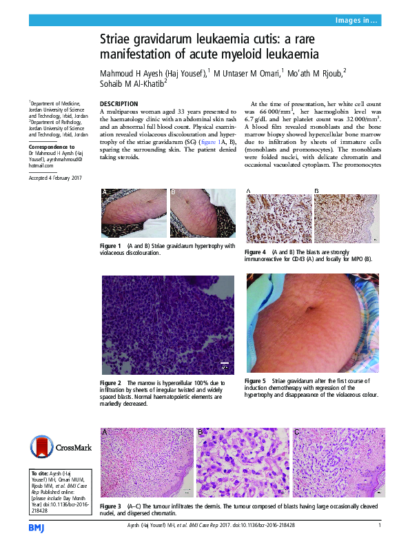 (PDF) Striae gravidarum leukaemia cutis: a rare manifestation of acute myeloid leukaemia
