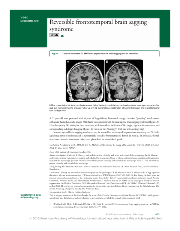 (PDF) Reversible frontotemporal brain sagging syndrome