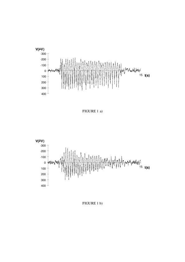 (PDF) Correlation Dimension Maps of EEG from Epileptic Absences