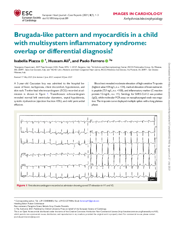 (PDF) Brugada-like pattern and myocarditis in a child with multisystem ...