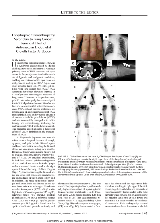 (PDF) Hypertrophic Osteoarthropathy Secondary to Lung Cancer