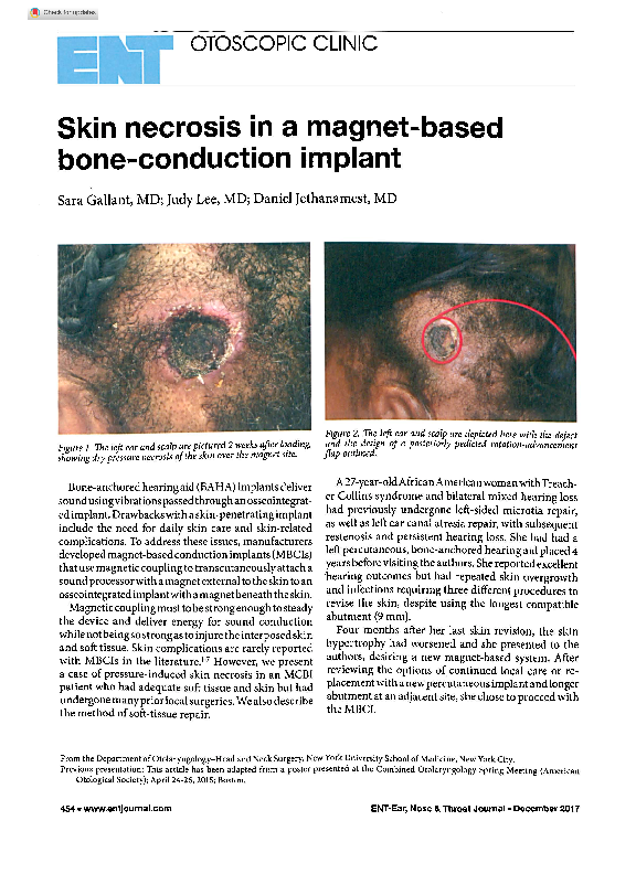(PDF) Skin Necrosis in a Magnet-Based Bone-Conduction Implant | Sara ...