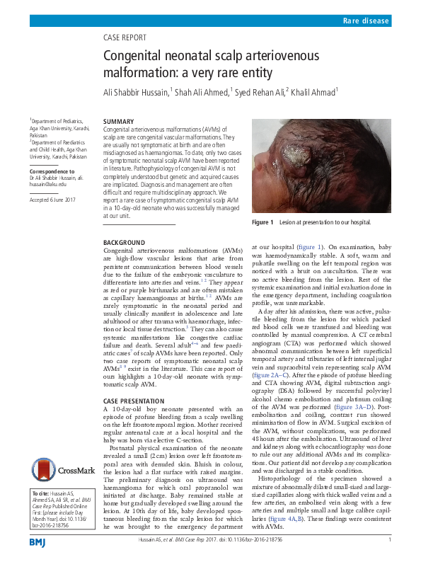 (PDF) Congenital neonatal scalp arteriovenous malformation: a very rare ...