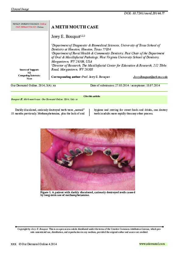 (PDF) A Meth mouth case | Jerry E Bouquot - Academia.edu