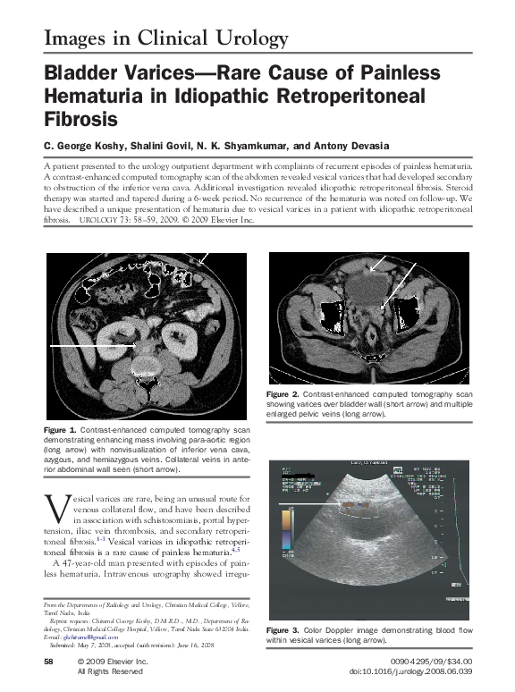 (PDF) Bladder Varices—Rare Cause of Painless Hematuria in Idiopathic ...