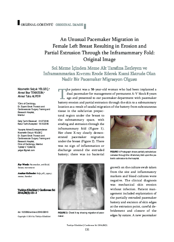 (PDF) An Unusual Pacemaker Migration in Female Left Breast Resulting in ...