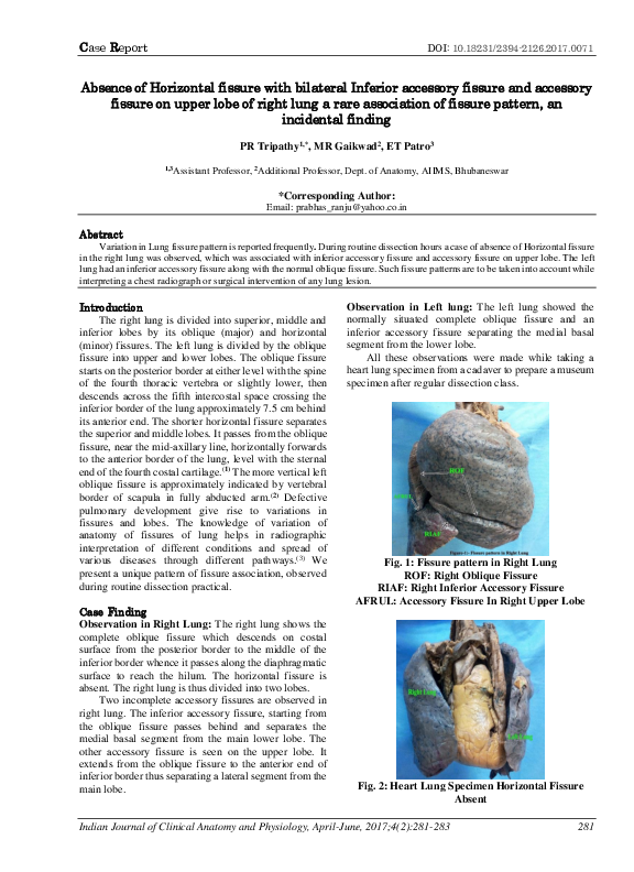 (PDF) Absence of Horizontal fissure with bilateral Inferior accessory ...