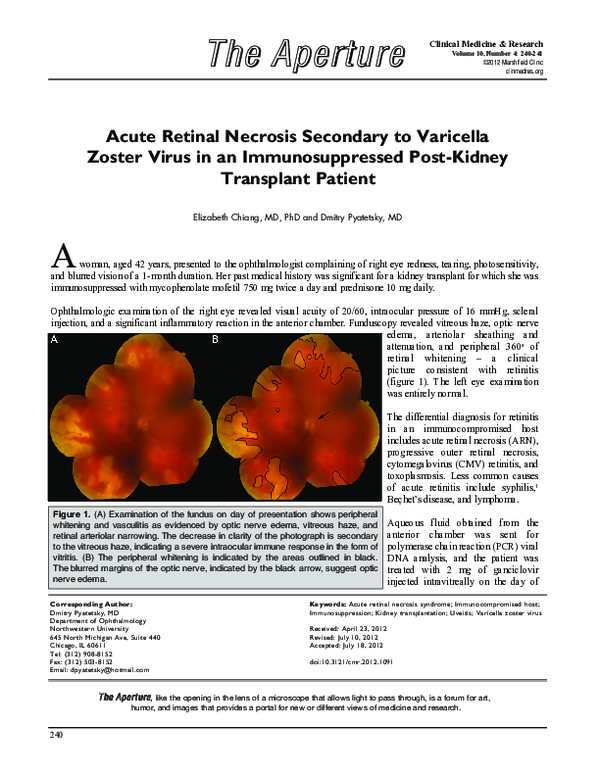 (PDF) Acute Retinal Necrosis Secondary to Varicella Zoster Virus in an ...