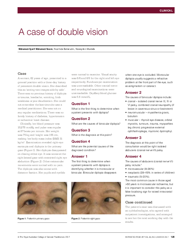 (PDF) A case of double vision