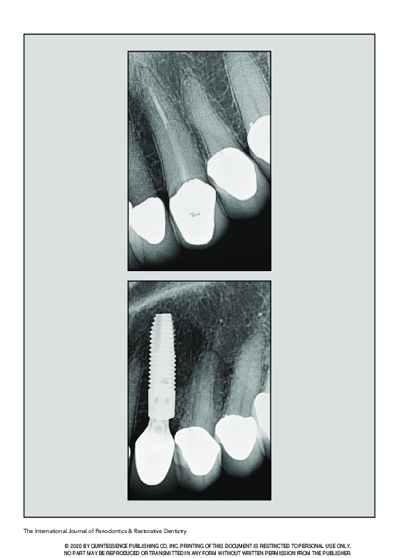 (PDF) Changes in Peri-implant Soft Tissue Thickness with Bone Grafting ...
