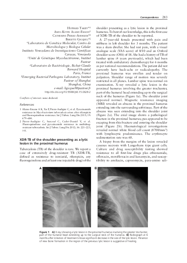 (PDF) XDR-TB of the shoulder presenting as a lytic lesion in the ...
