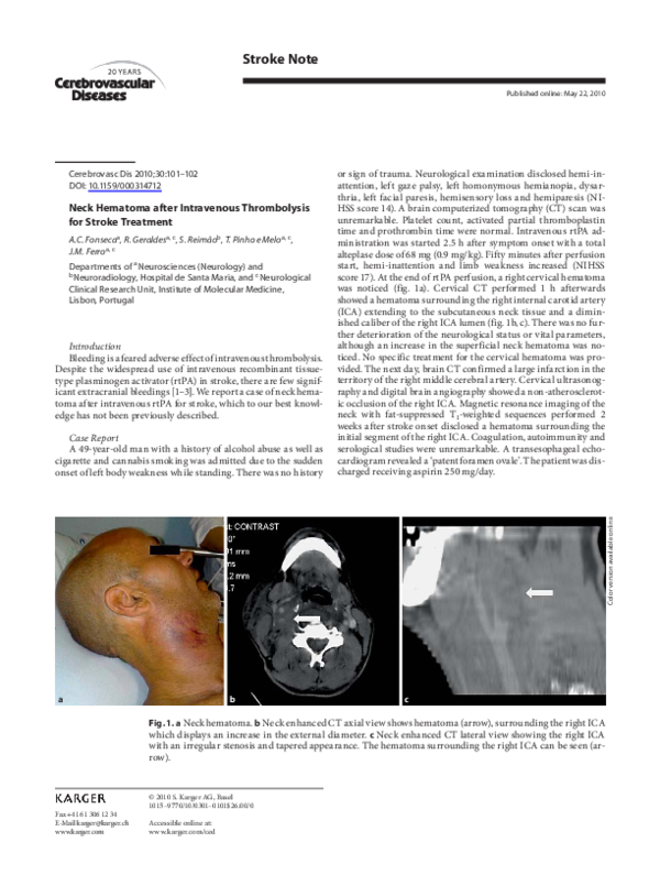 (PDF) Neck Hematoma after Intravenous Thrombolysis for Stroke Treatment