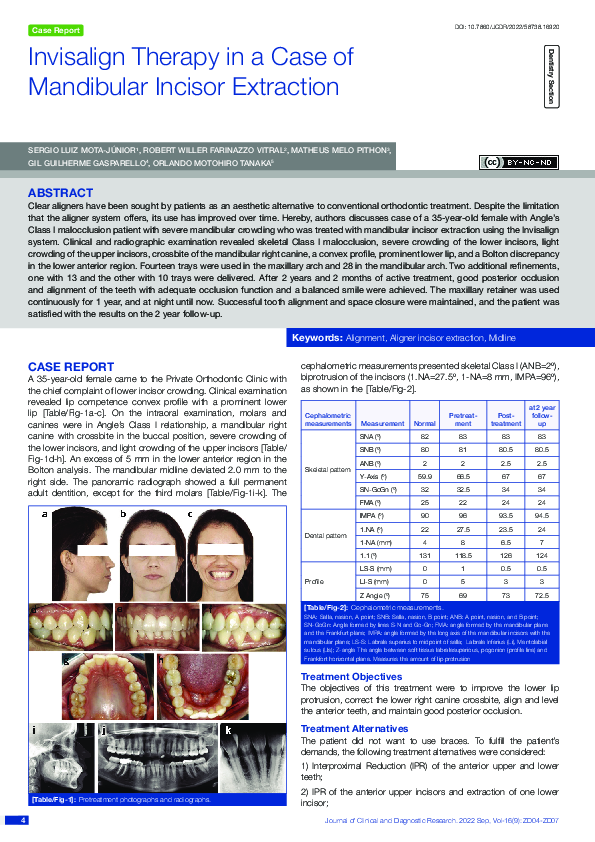(PDF) Invisalign Therapy in a Case of Mandibular Incisor Extraction