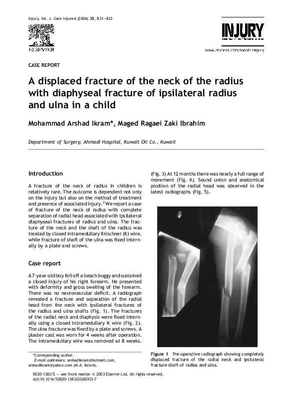 (PDF) A displaced fracture of the neck of the radius with diaphyseal ...