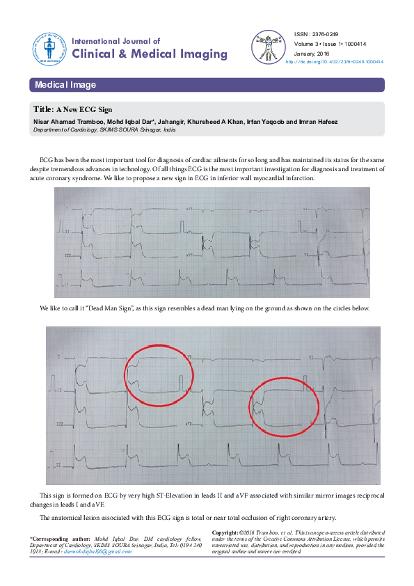 (PDF) A New ECG Sign