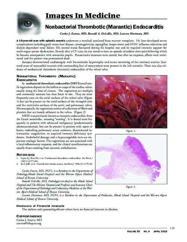 (PDF) Nonbacterial thrombotic (marantic) endocarditis