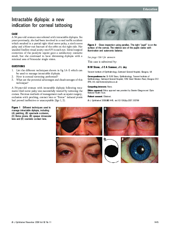 (PDF) Intractable diplopia: a new indication for corneal tattooing