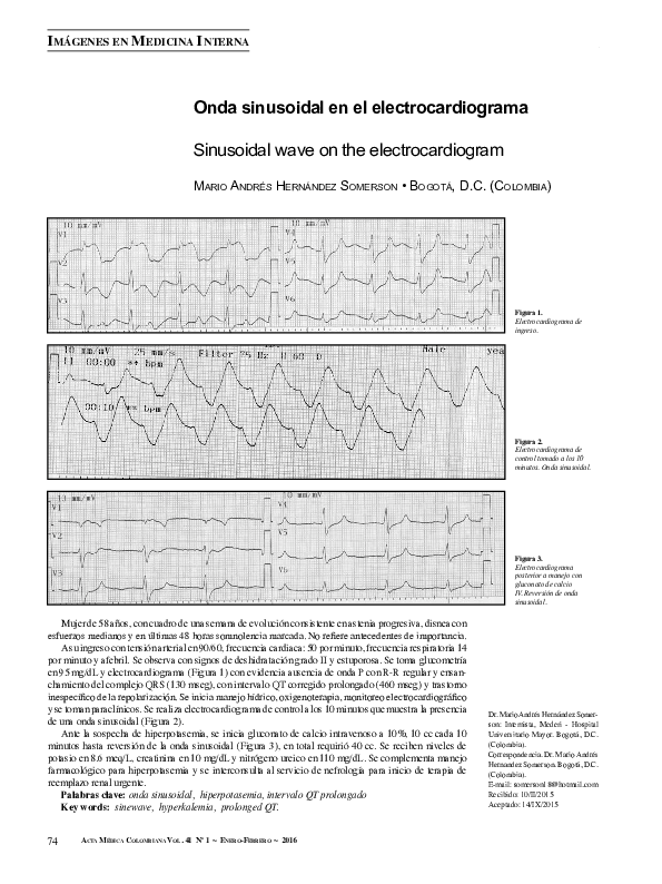 (PDF) Onda sinusoidal en el electrocardiograma