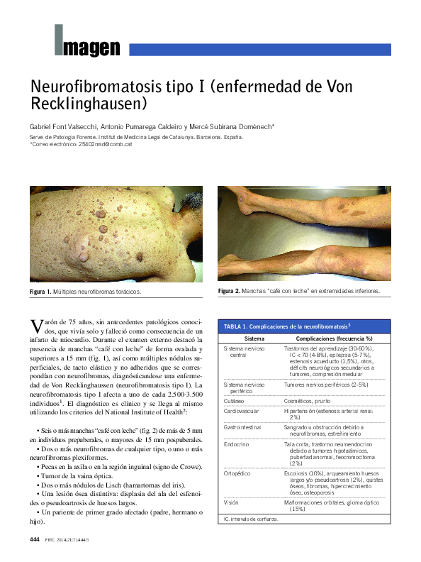 (PDF) Neurofibromatosis tipo I (enfermedad de Von Recklinghausen)