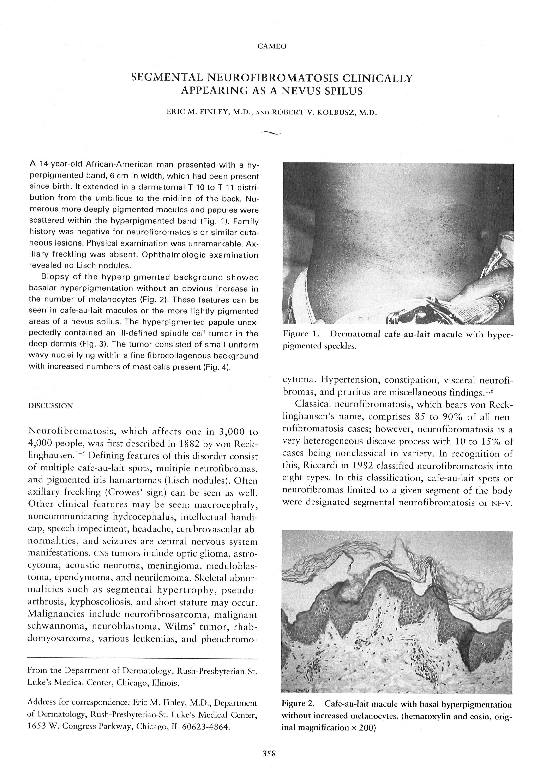 (PDF) Segmental Neurofibromatosis Clinically Appearing as a Nevus ...